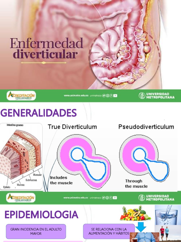Enfermedad Diverticular | PDF | Medicina CLINICA | Enfermedades y trastornos