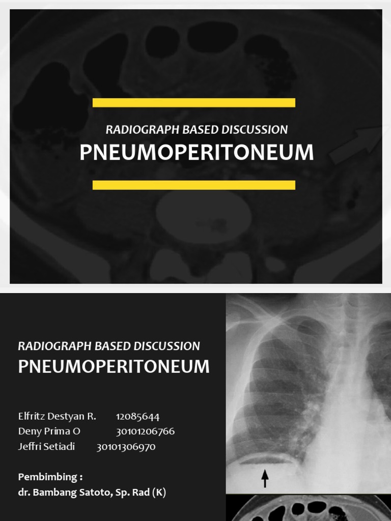 RBD Pneumoperitoneum | PDF