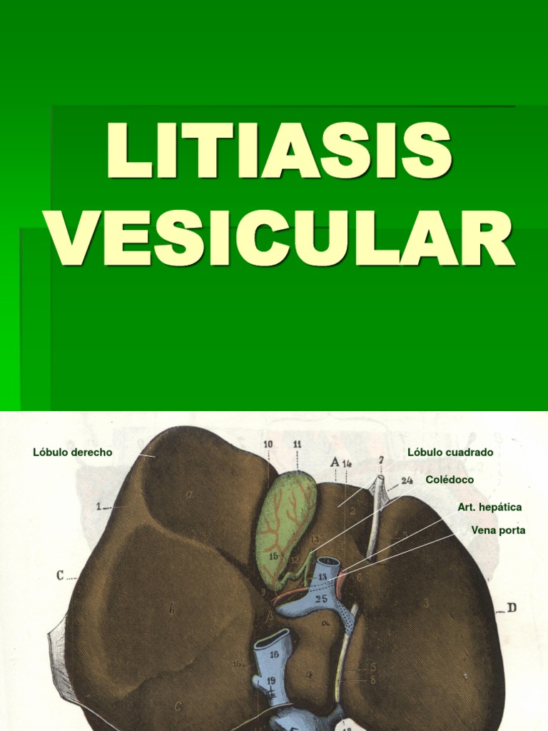 Litiasis Vesicular | PDF | Vesícula biliar | Bilis