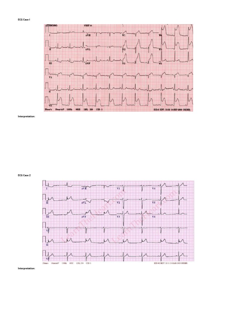ECG Case | PDF