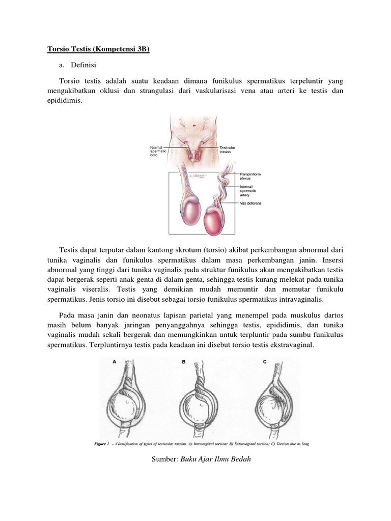 Torsio Testis | PDF