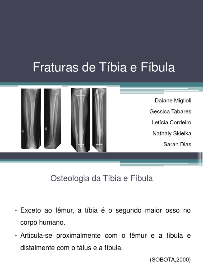 Fraturas da Tíbia e Fíbula: Tipos e Tratamento | PDF | Joelho | Membros ...