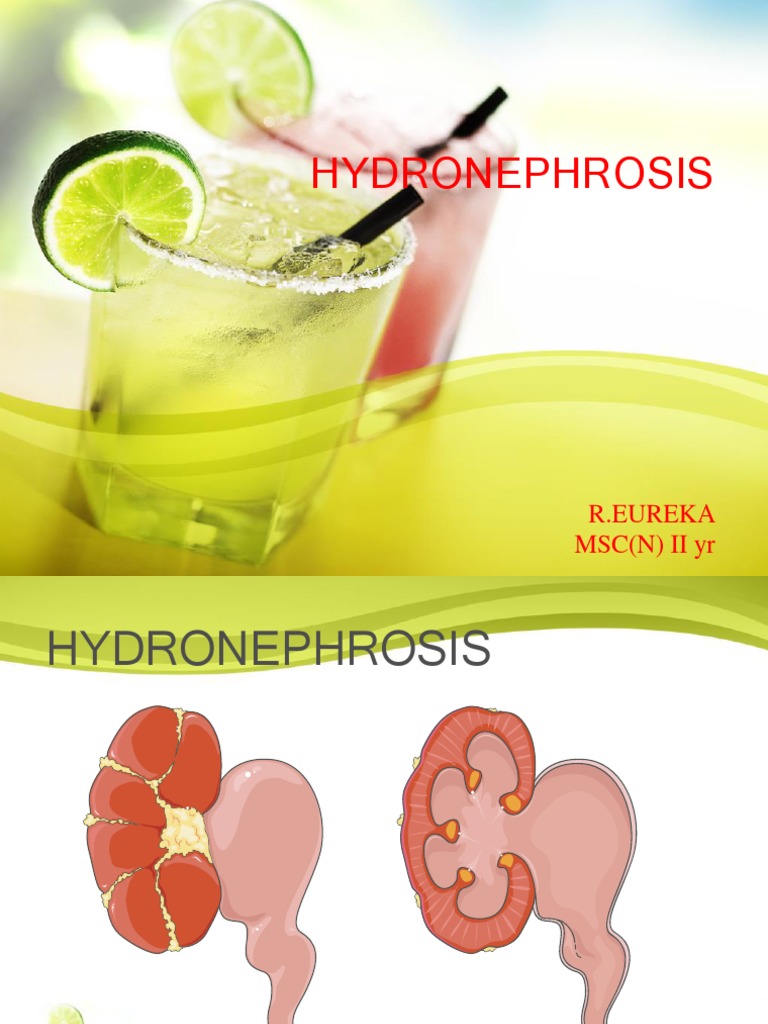 Hydronephrosis | PDF | Urology | Urinary System