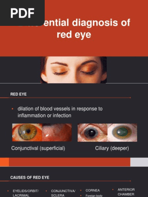Ciliary Flush Vs Conjunctivitis
