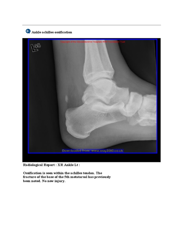 Ankle Achilles Ossification | PDF | Ankle | Human Anatomy
