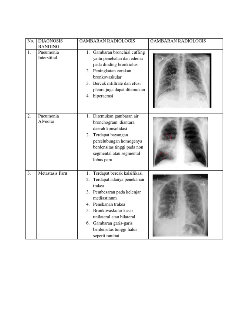 Diagnosis Banding Opasitas Pada Rontgen Thorax