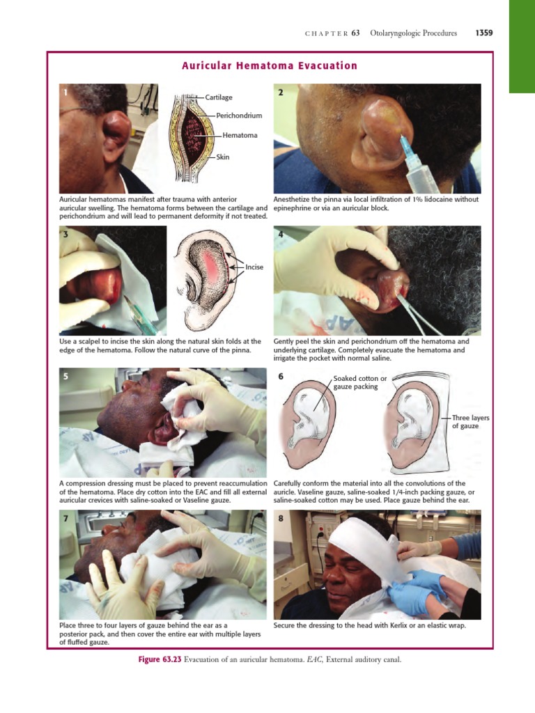 Auricular Hematoma Procedure PDF | PDF | Ear | Human Head And Neck