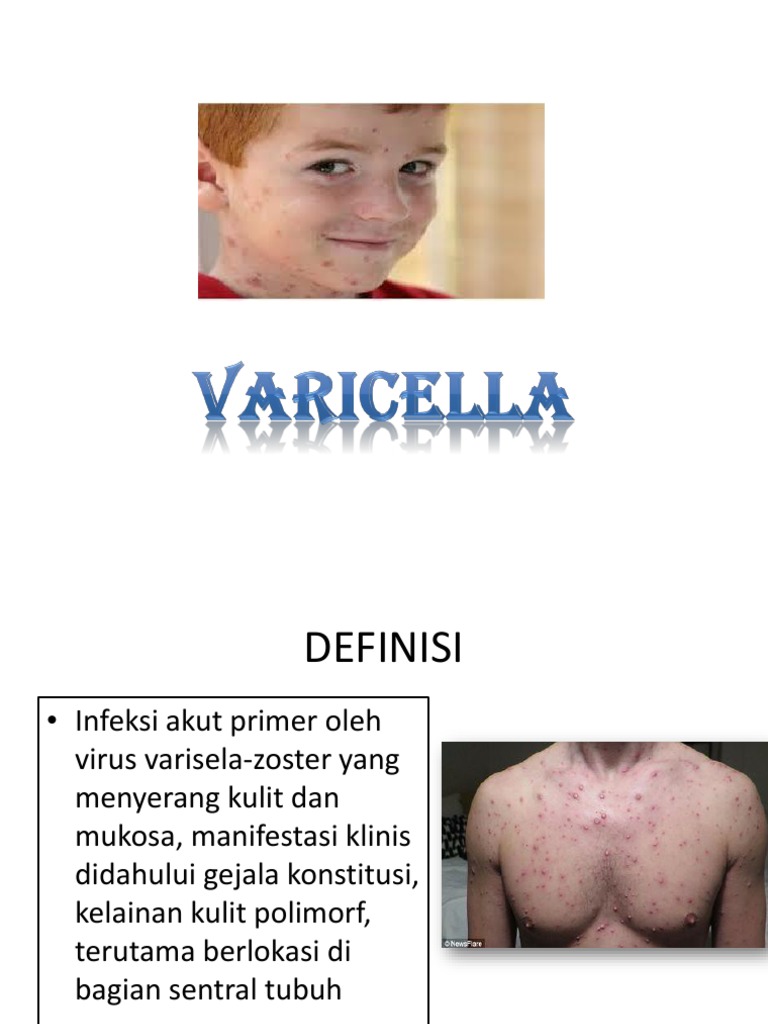 Varicella | PDF