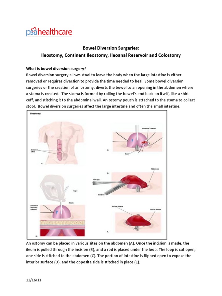 Bowel Diversion Surgeries: Ileostomy, Continent Ileostomy, Ileoanal ...