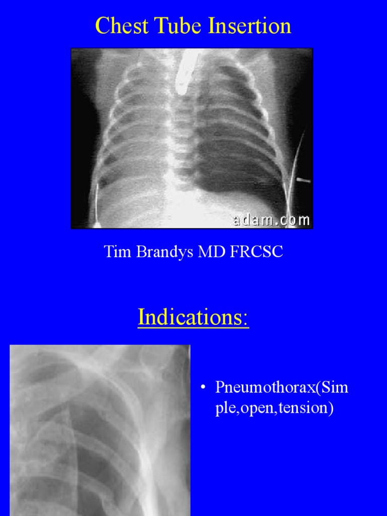 Chest Tube Insertion: Tim Brandys MD FRCSC | PDF