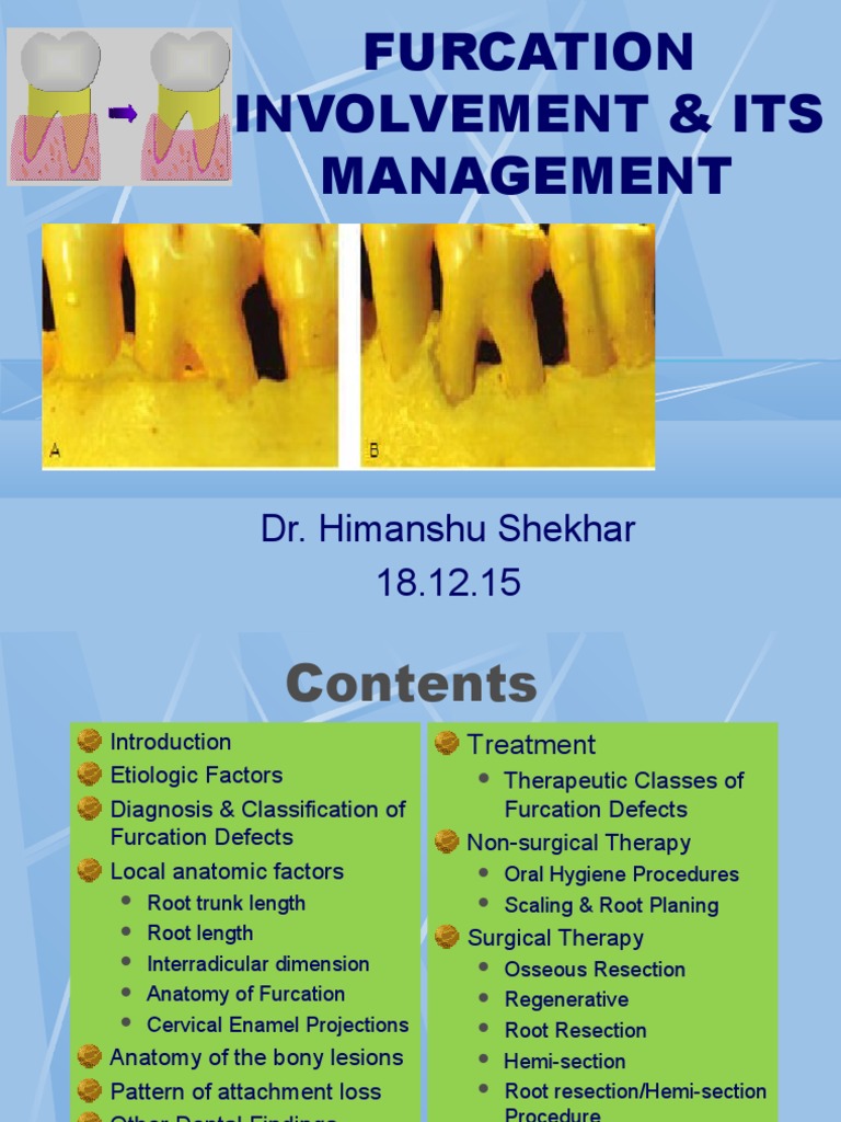 Understanding Furcation Involvement: A Comprehensive Review of the ...
