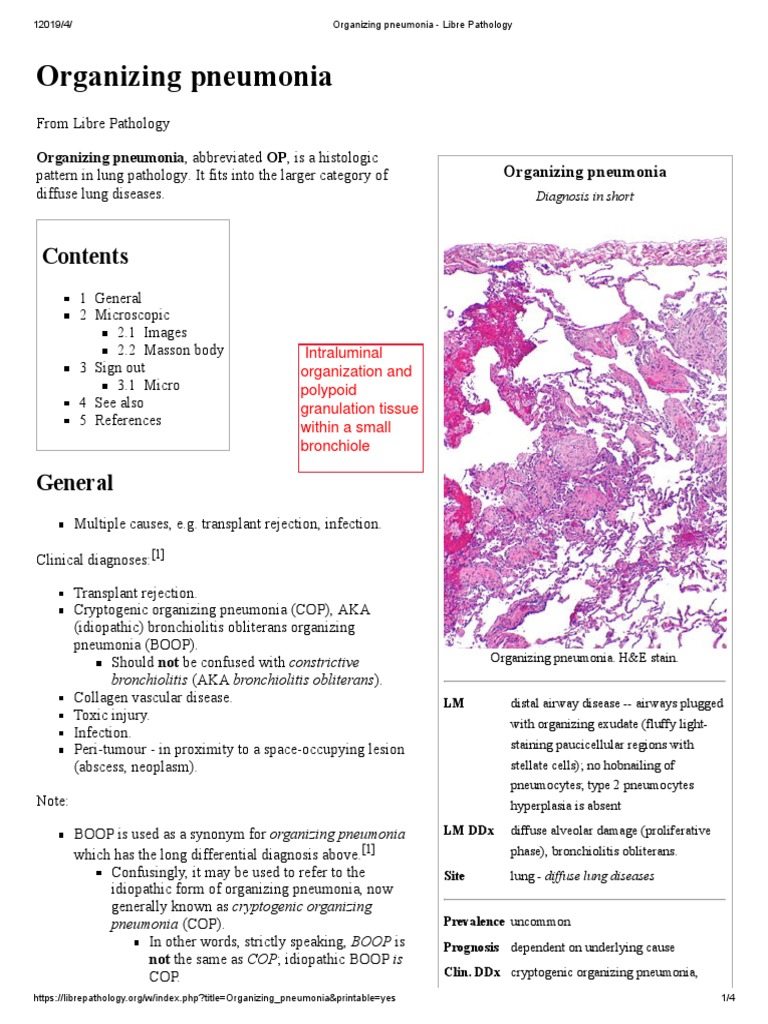 16 Organizing Pneumonia - Libre Pathology | PDF | Pneumonia | Lung