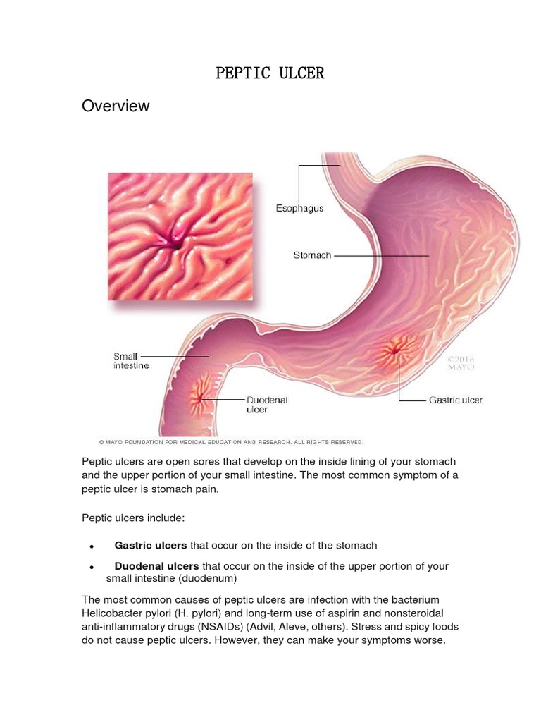 The Nursing Assessment of Peptic Ulcer | PDF | Gastroenterology ...