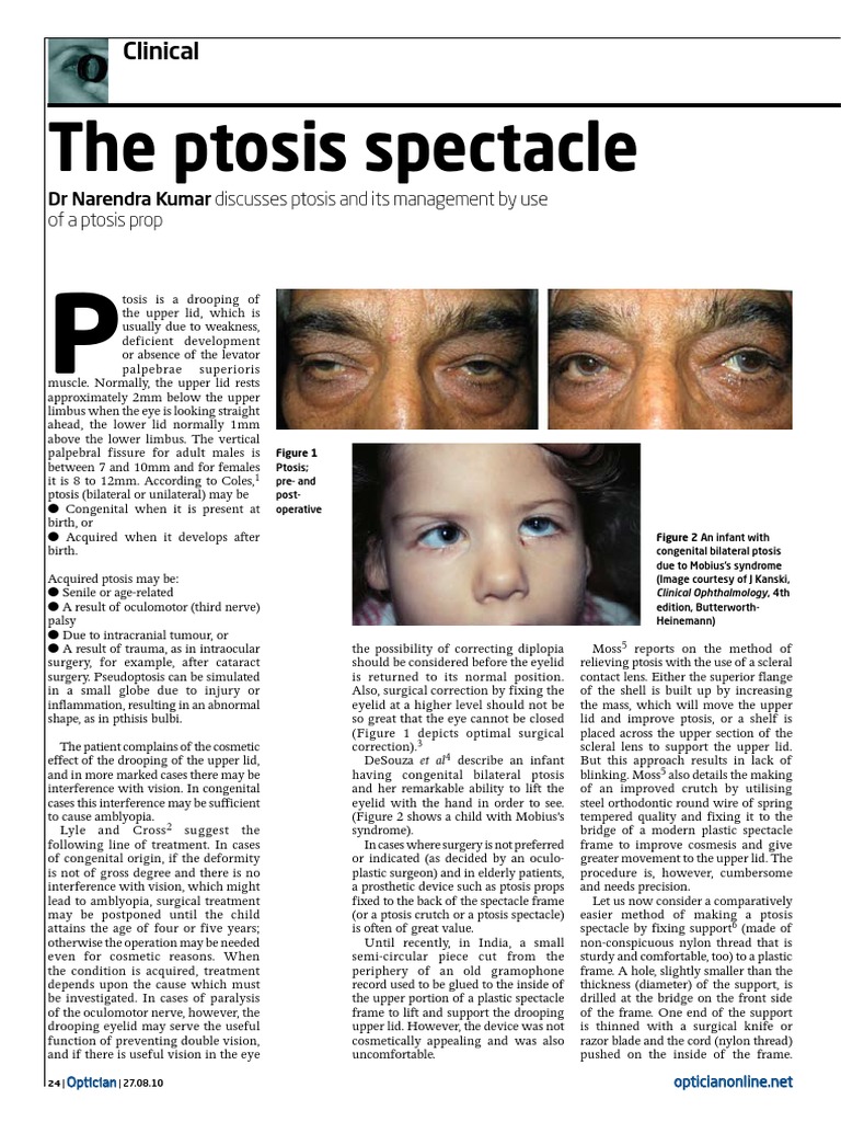 The Ptosis Spectacle PDF | PDF | Diseases Of The Eye And Adnexa | Eye