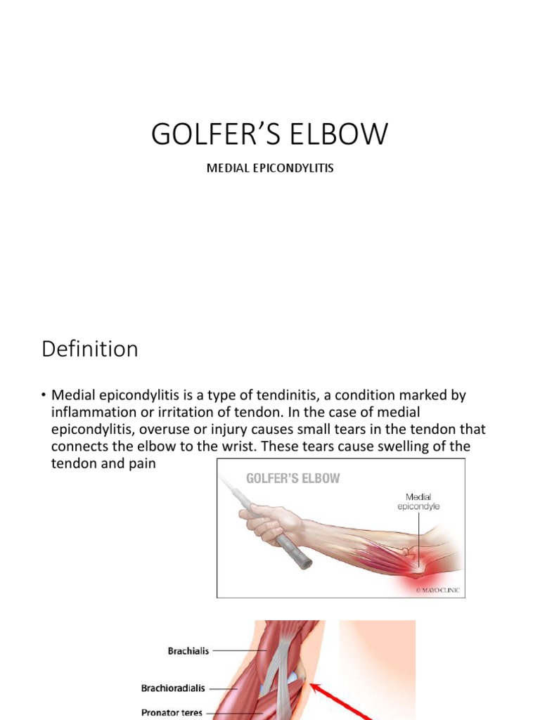 Golfer S Elbow Medial Epicondylitis Pdf