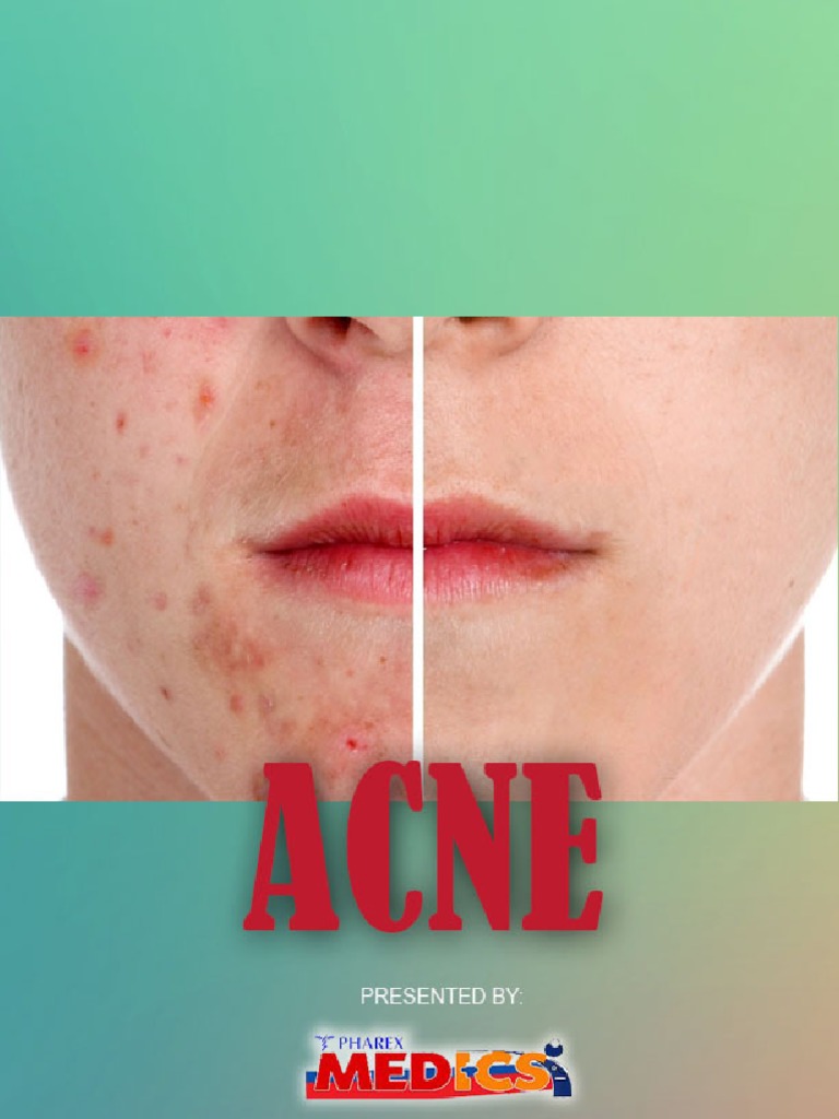 Acne PDF | PDF | Health Sciences | Medicine