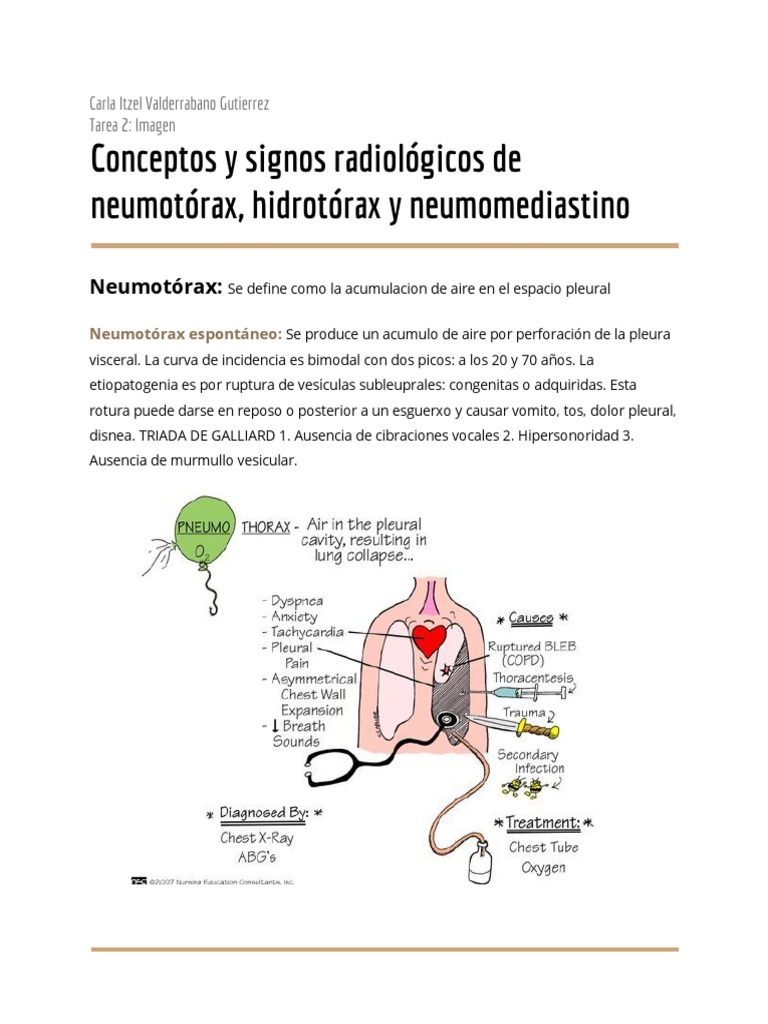 Signos Radiológicos de Neumotórax y Hidrotórax | PDF | Tórax (anatomía ...