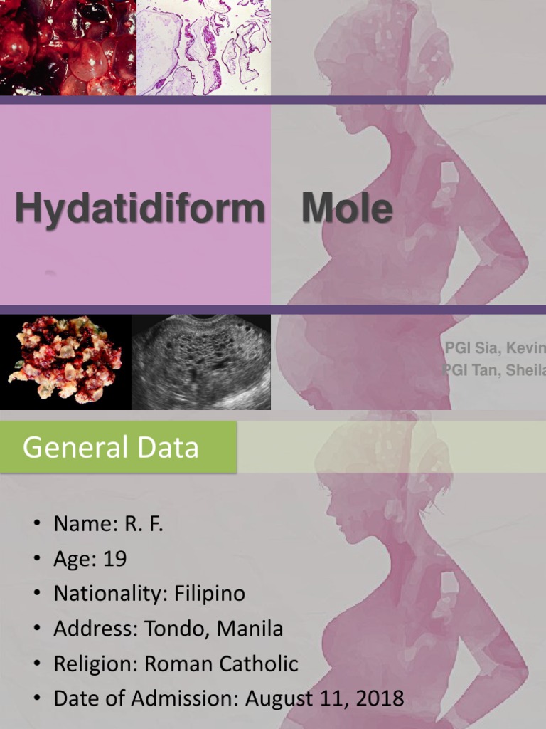 Hydatidiform Mole: PGI Sia, Kevin PGI Tan, Sheila | PDF | Human ...