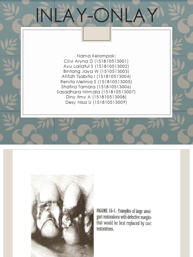 Proses Inlay dan Onlay pada Gigi | PDF | Griya & Taman