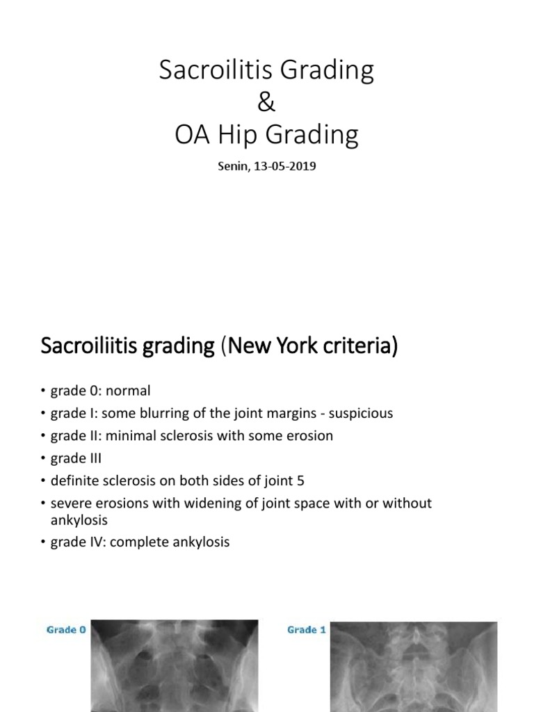 Sacroilitis Grading | Arthritis | Musculoskeletal System