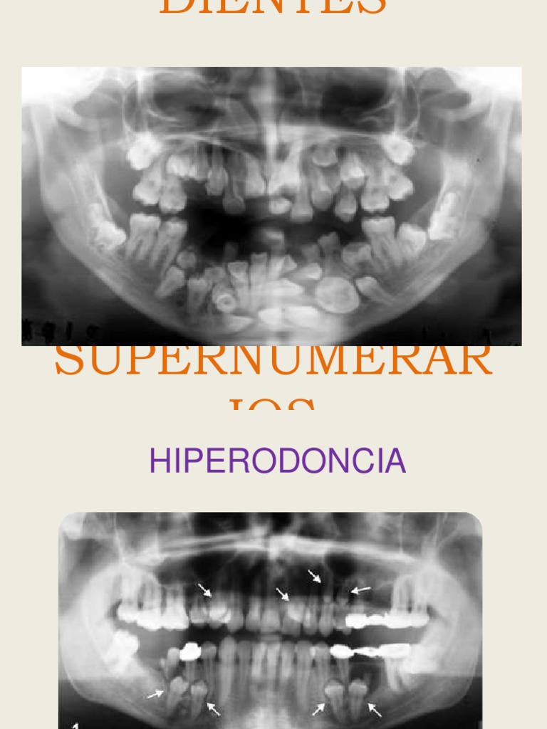 Dientes Supernumerarios | PDF | Diente | Anatomia dental