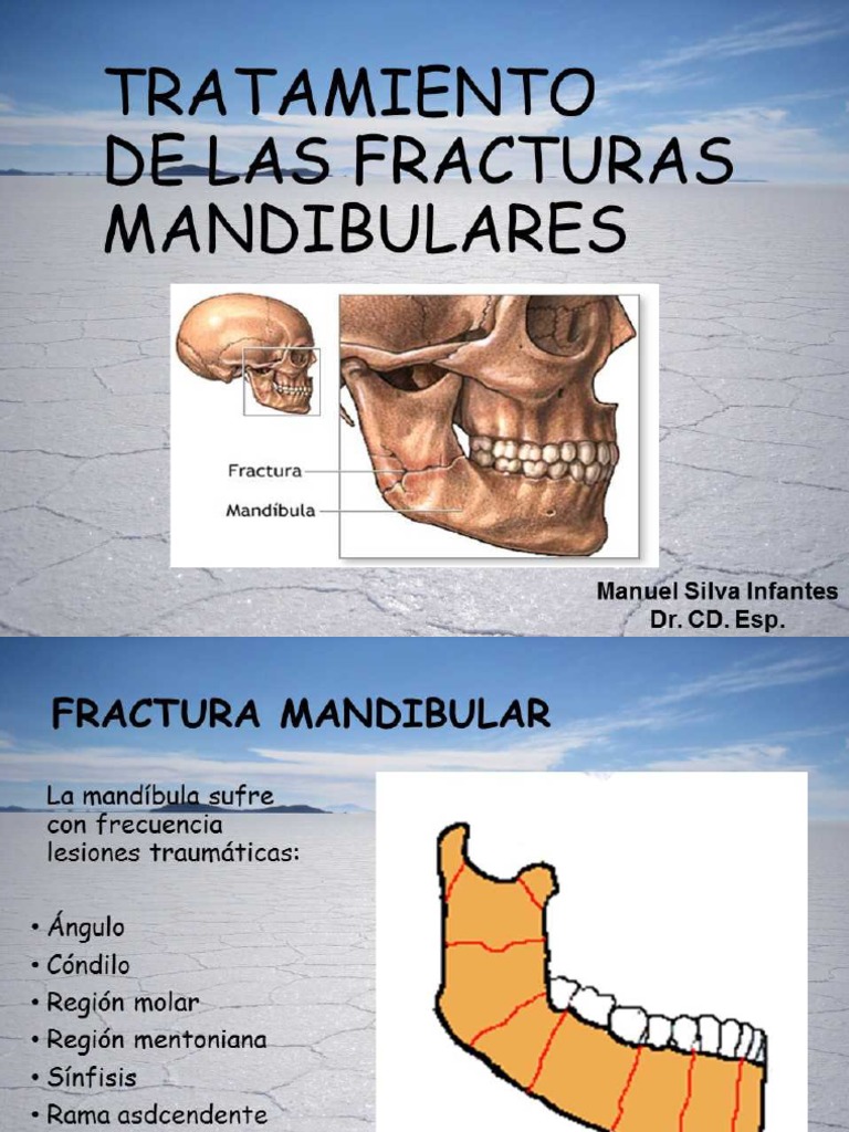 22 Tratamiento de Las Fracturas Mandibulares | PDF