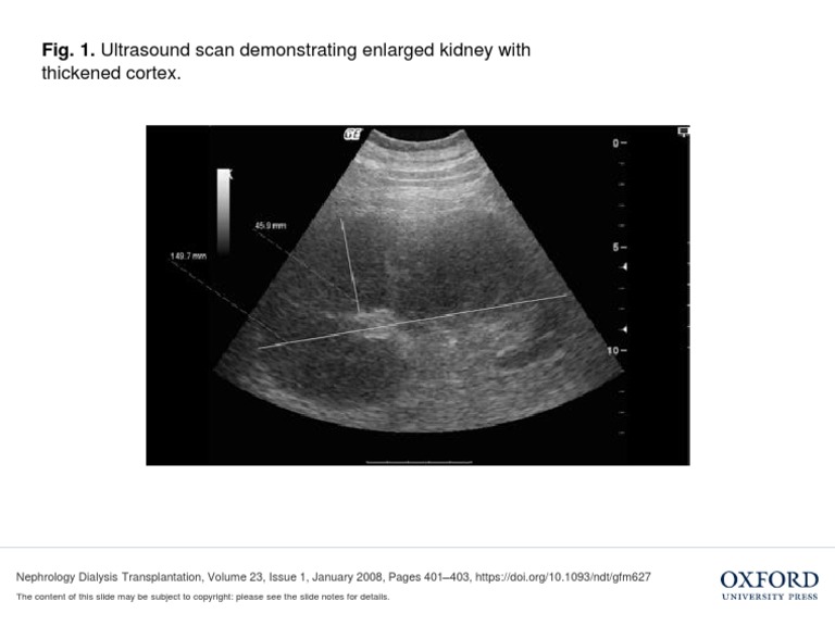 Thickened Cortex.: Fig. 1. Ultrasound Scan Demonstrating Enlarged ...