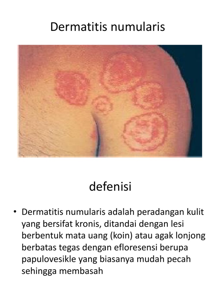 Dermatitis Numularis | PDF
