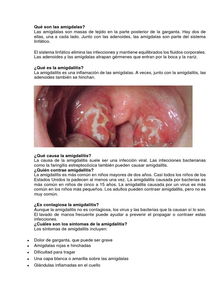 AMIGDALITIS | PDF | Estreptococo | Alimentos