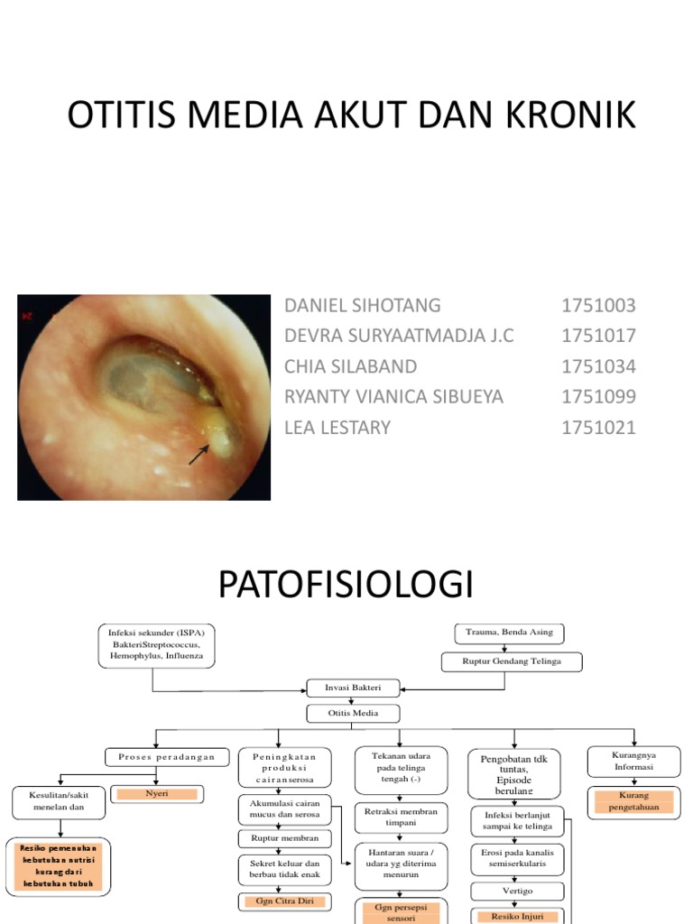 Otitis Media Akut Dan Kronik | PDF