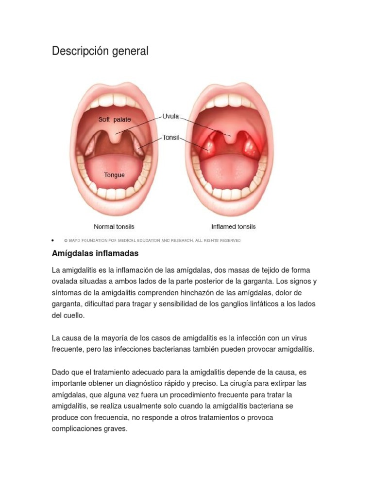 Amigdalitis | PDF | Estreptococo | Inflamación