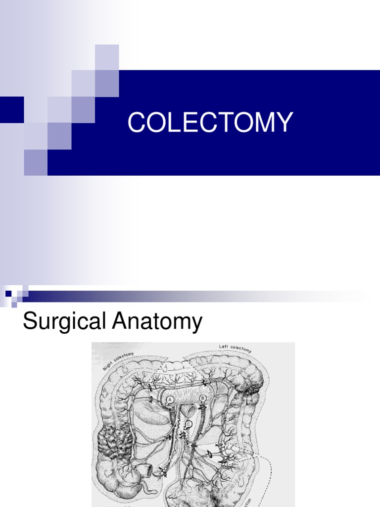 TO Colectomy | PDF