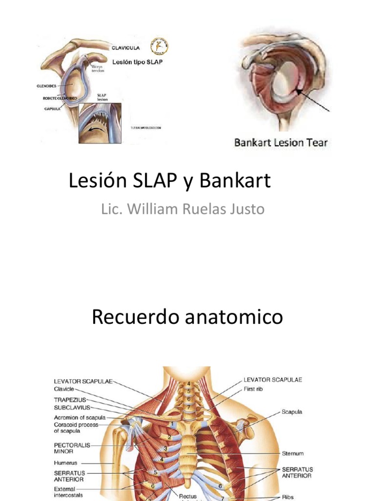 Lesión SLAP y Bankart | PDF | Hombro | Extremidades (anatomía)