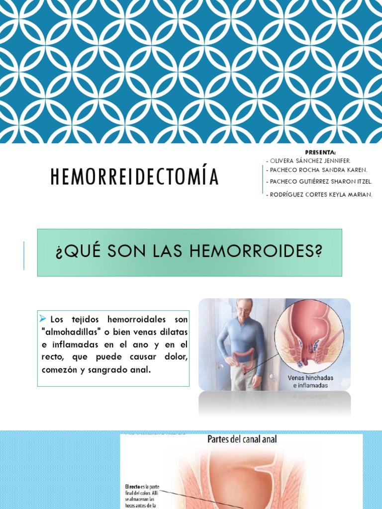 HEMORROIDECTOMÍA | PDF | Hemorroides | Recto
