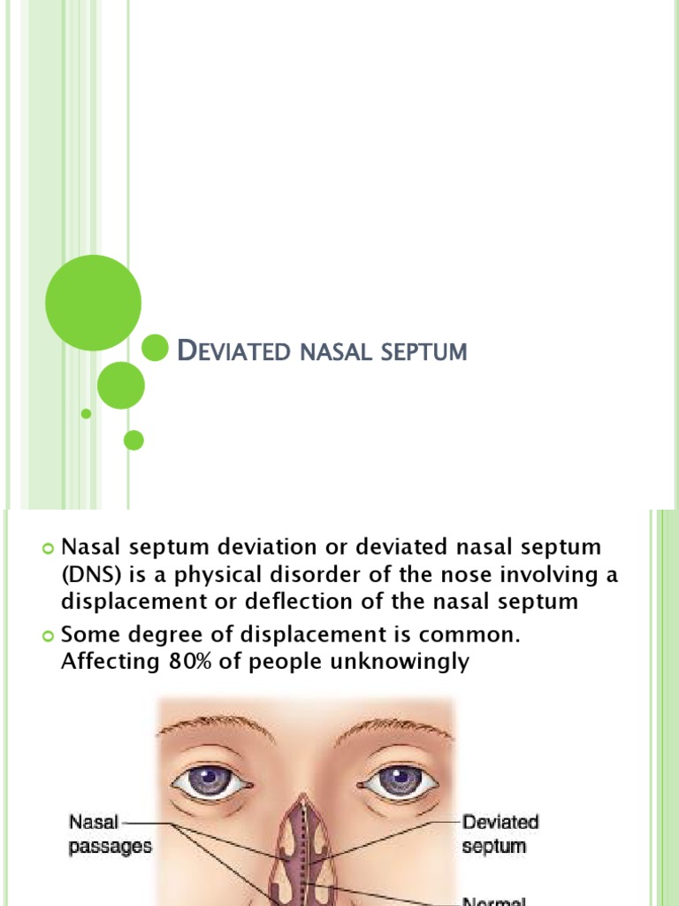 Deviated Nasal Septum | PDF | Human Nose | Clinical Medicine