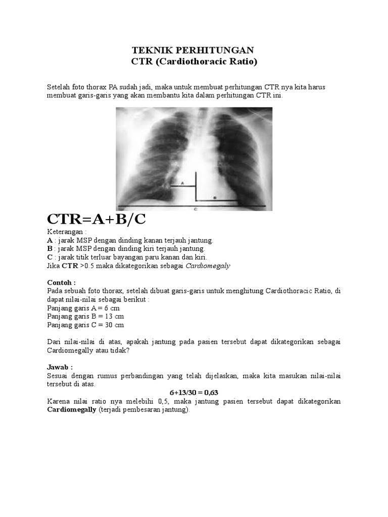 CTR A+B/C: Teknik Perhitungan CTR (Cardiothoracic Ratio) | PDF | Metode ...