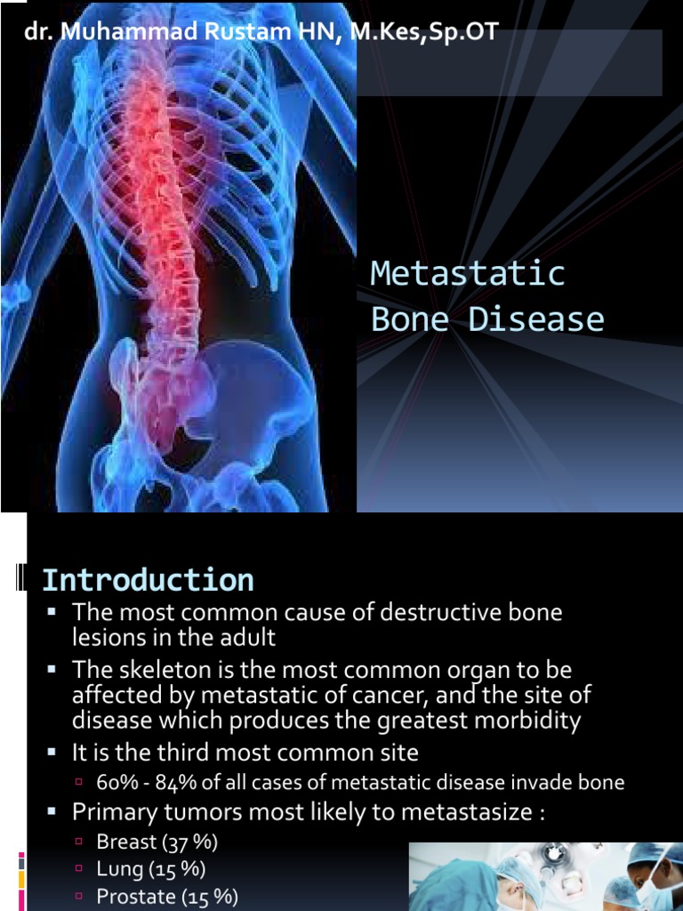 Metastatic Bone Disease Overview | PDF | Metastasis | Bone