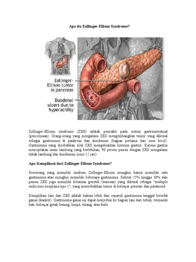 Zollinger - Ellison Syndrome | PDF