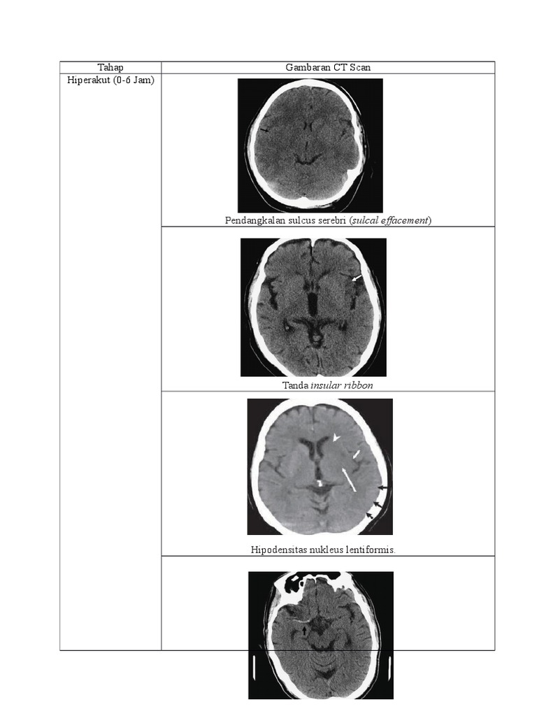 Tabel Gambaran CT Scan | PDF