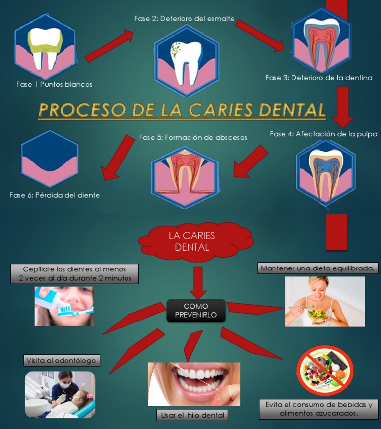 Proceso de La Caries Dental | PDF