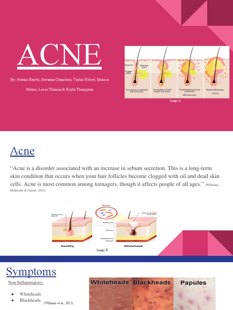 Acne | PDF | Health Sciences | Skin