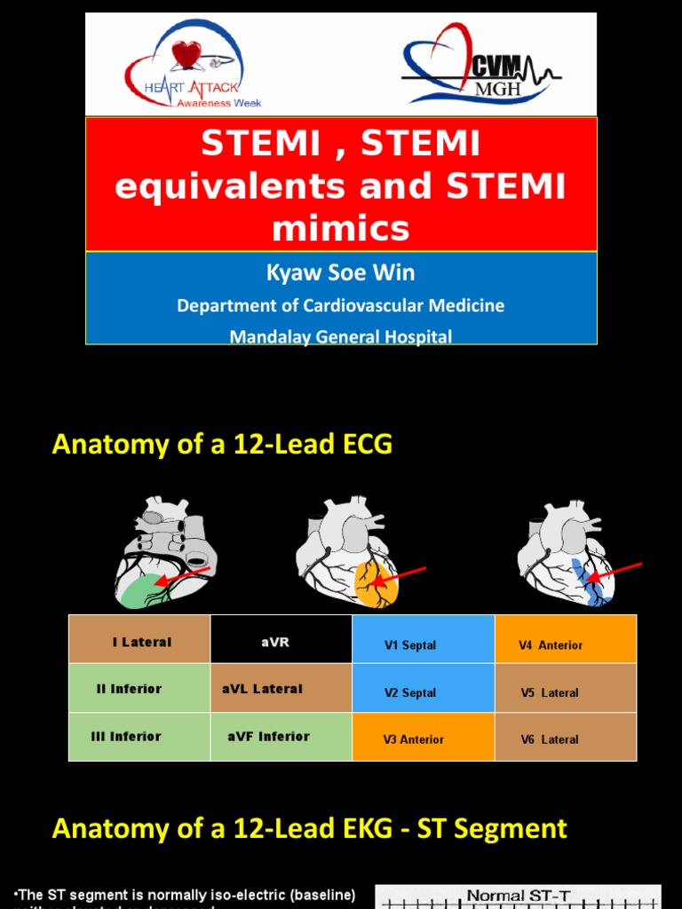 Stemi, Stemi Equivalents and STEMI Mimics: Kyaw Soe Win | Download Free ...