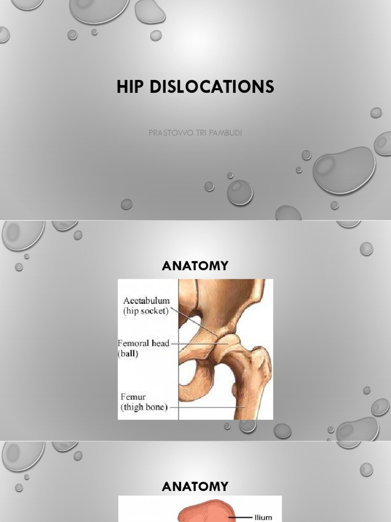 Hip Dislocations: Anatomy, Mechanisms, Classifications and Treatment ...