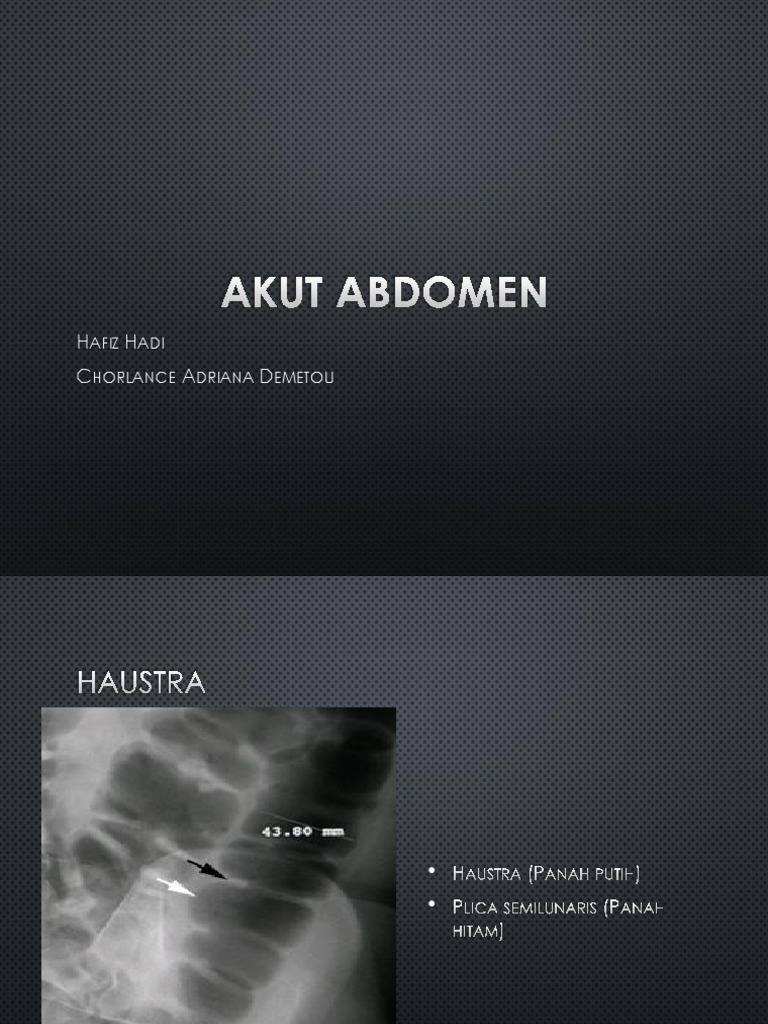 Akut Abdomen 2 | PDF