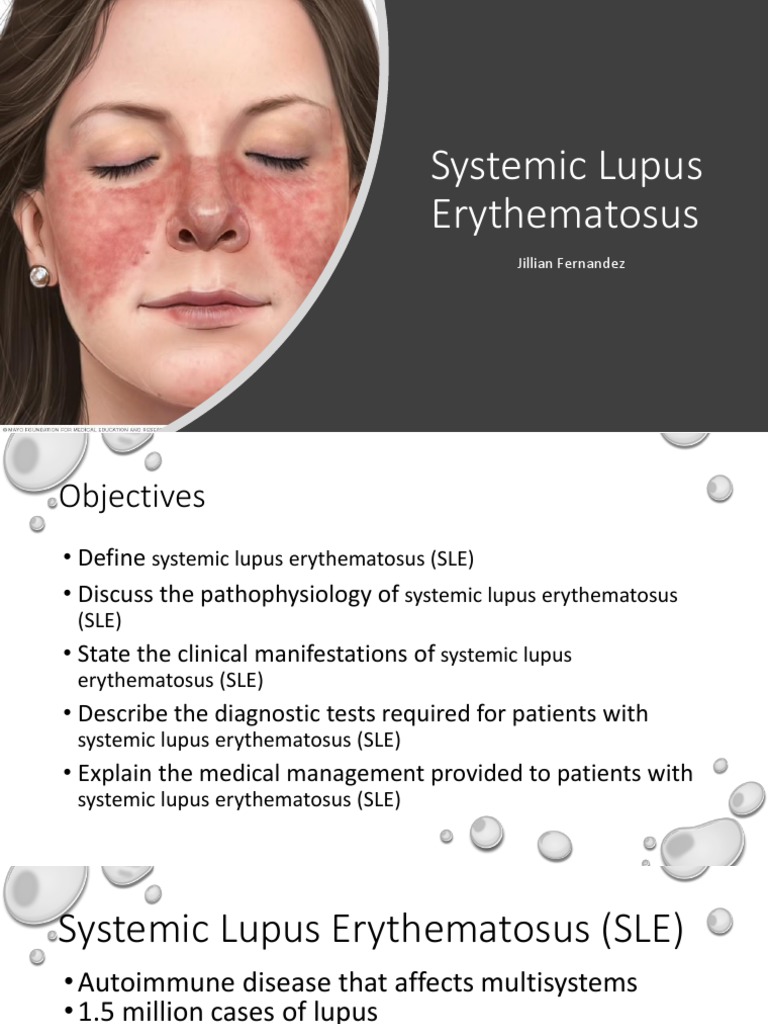 Systemic Lupus Erythematosus | PDF | Systemic Lupus Erythematosus ...