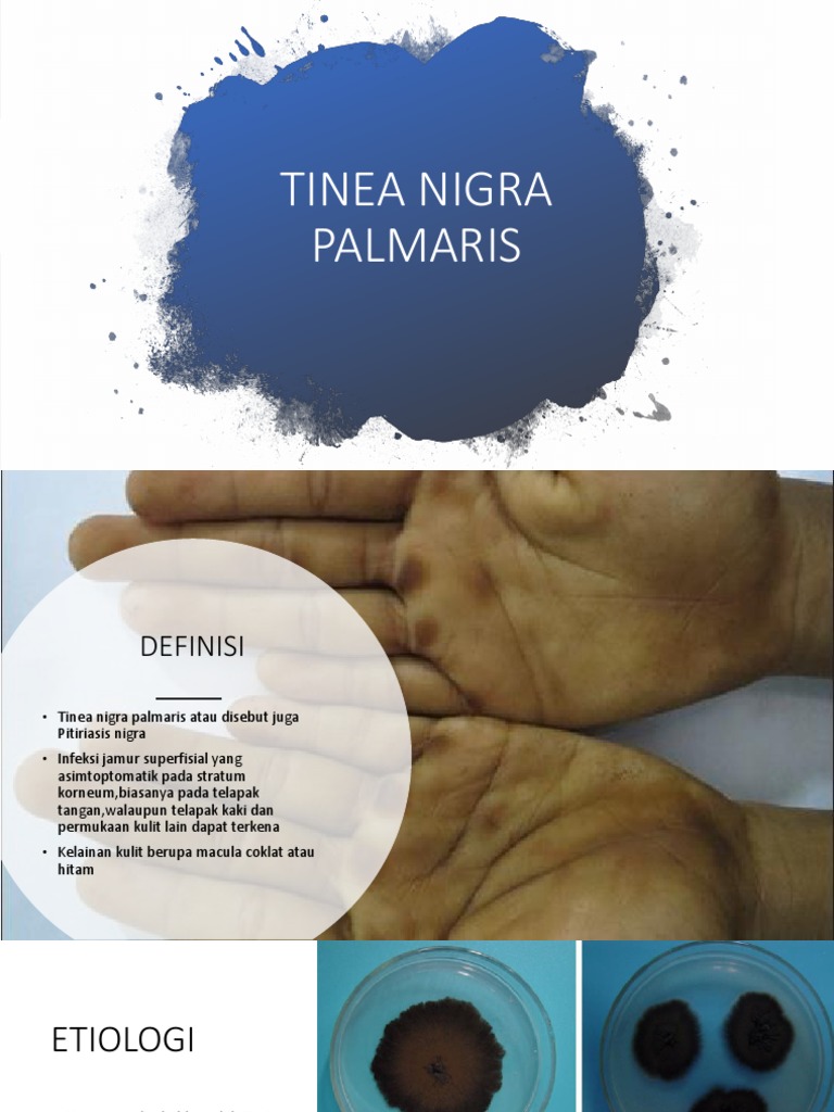 Tinea Nigra Palmaris | PDF