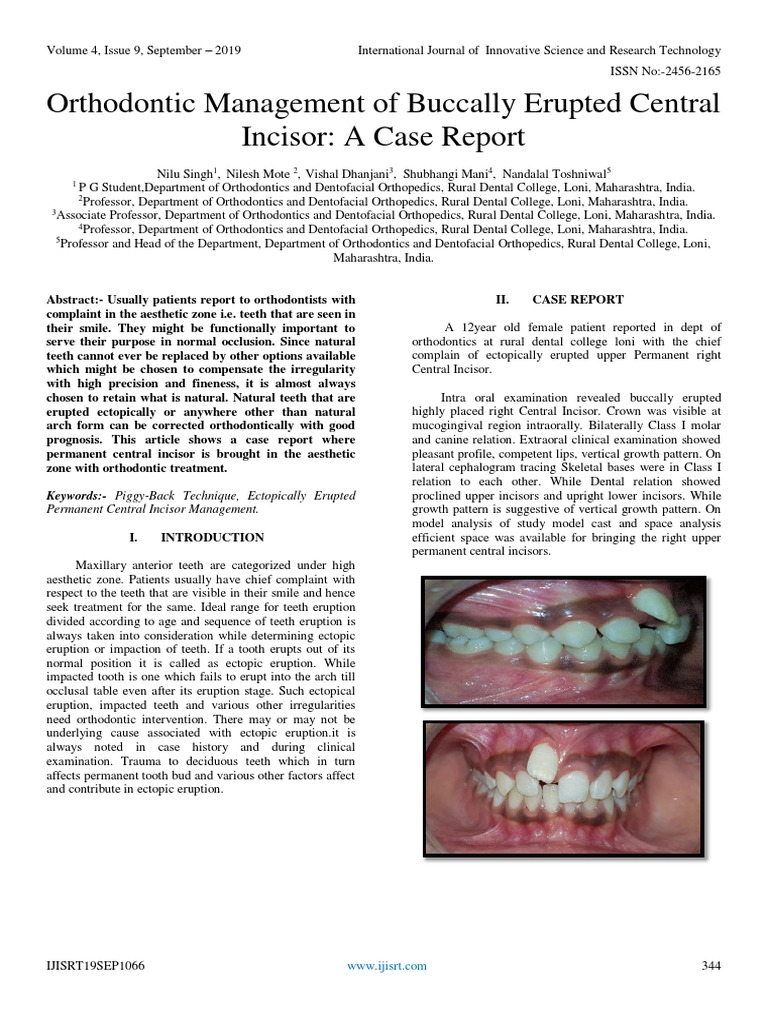 Orthodontic Management of Buccally Erupted Central Incisor: A Case ...