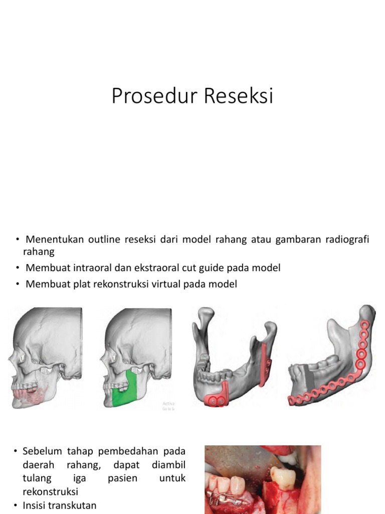 Prosedur Reseksi | PDF