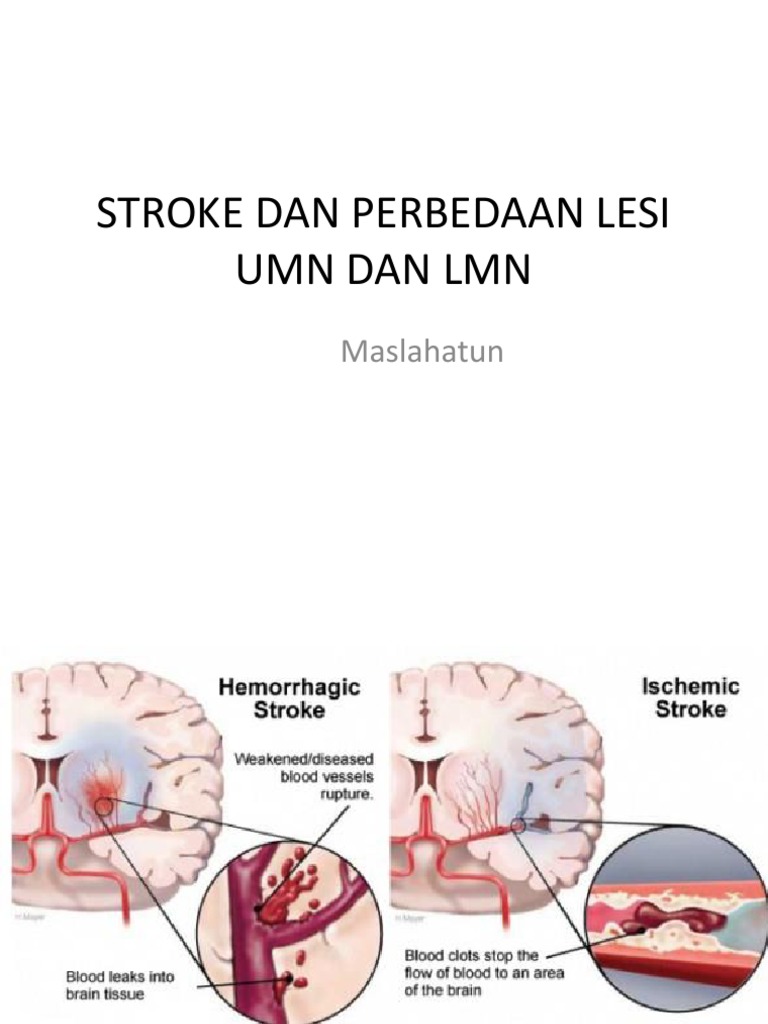 Stroke Dan Perbedaan Lesi Umn Dan LMN | PDF