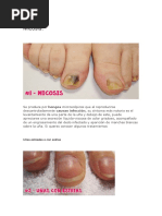 Acrodisostosis: Uñas Cortas y Anchas | PDF | Clavo (anatomía ...